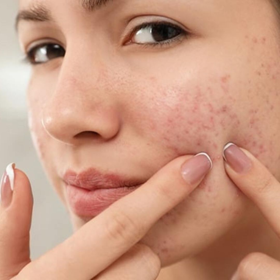 Goodbye Acne: 5 Beauty Tips for Clear Skin - Acne Skincare Routine